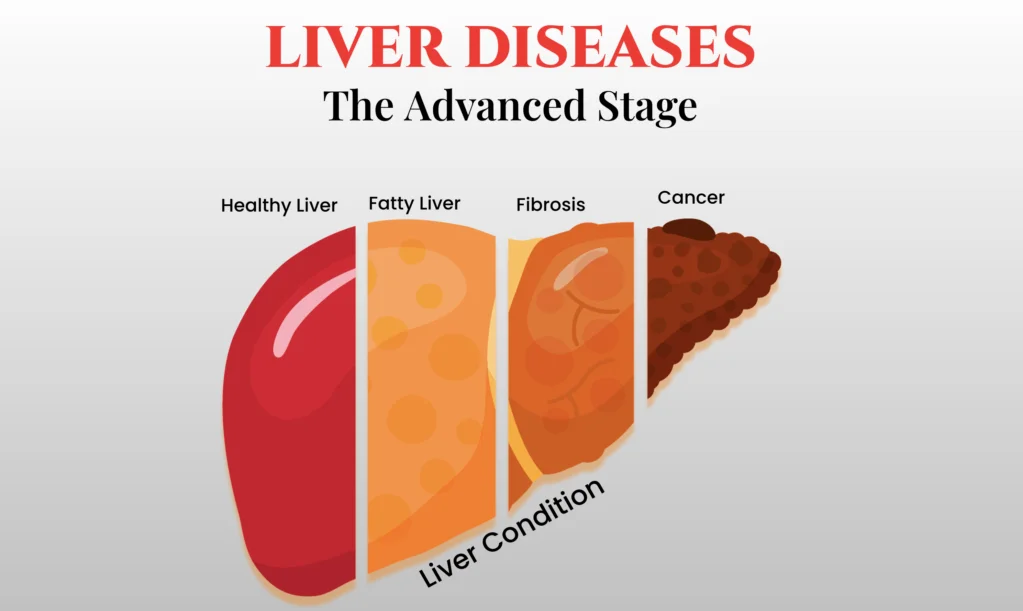 Liver Diseases- Causes, Symptoms, Diagnosis, and Treatment - Dr ...