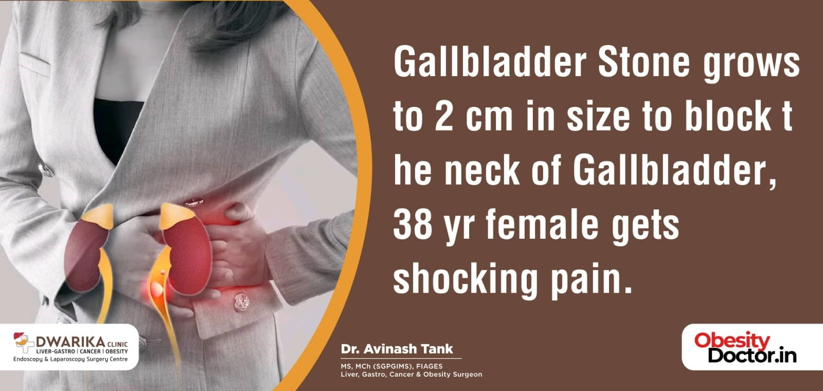 Gallbladder Stone grows to 2 cm in size to block the neck of ...