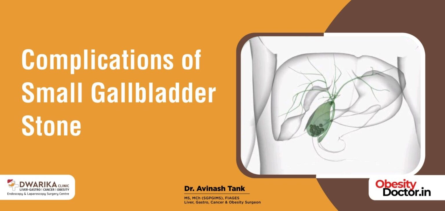 Complications of Small Gallbladder Stone - Dr AvinashTank, is a super ...