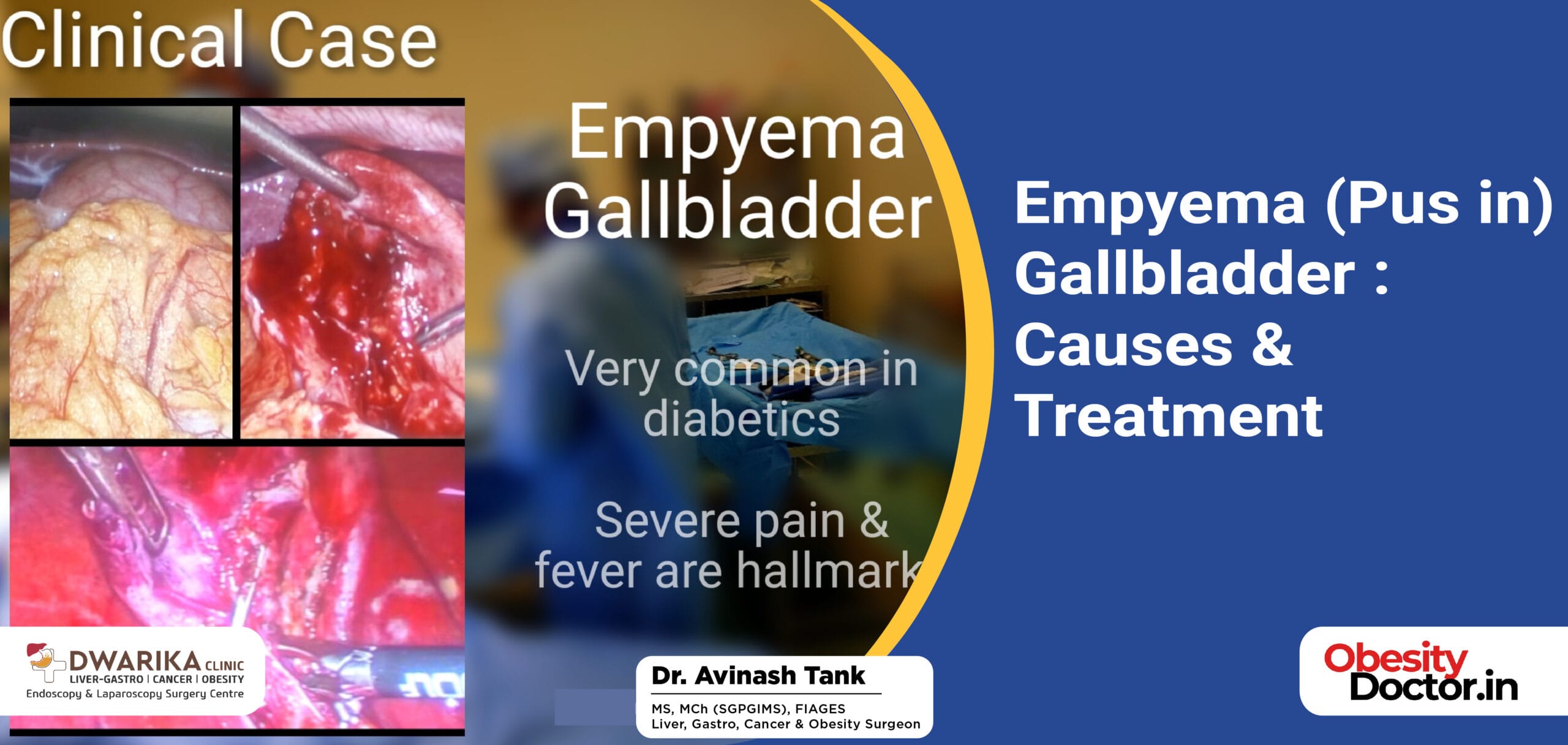 Empyema (Pus in) Gallbladder : Causes & Treatment - Dr AvinashTank, is a super-specialist (MCh ...