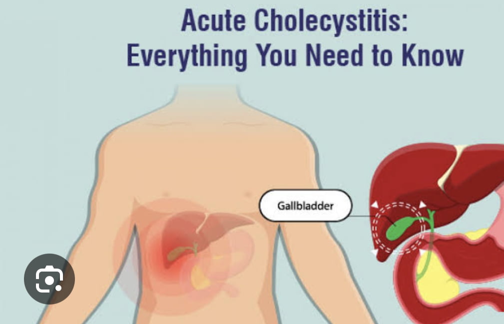 Acute Calculus Cholecystitis - Dr AvinashTank, is a super-specialist ...