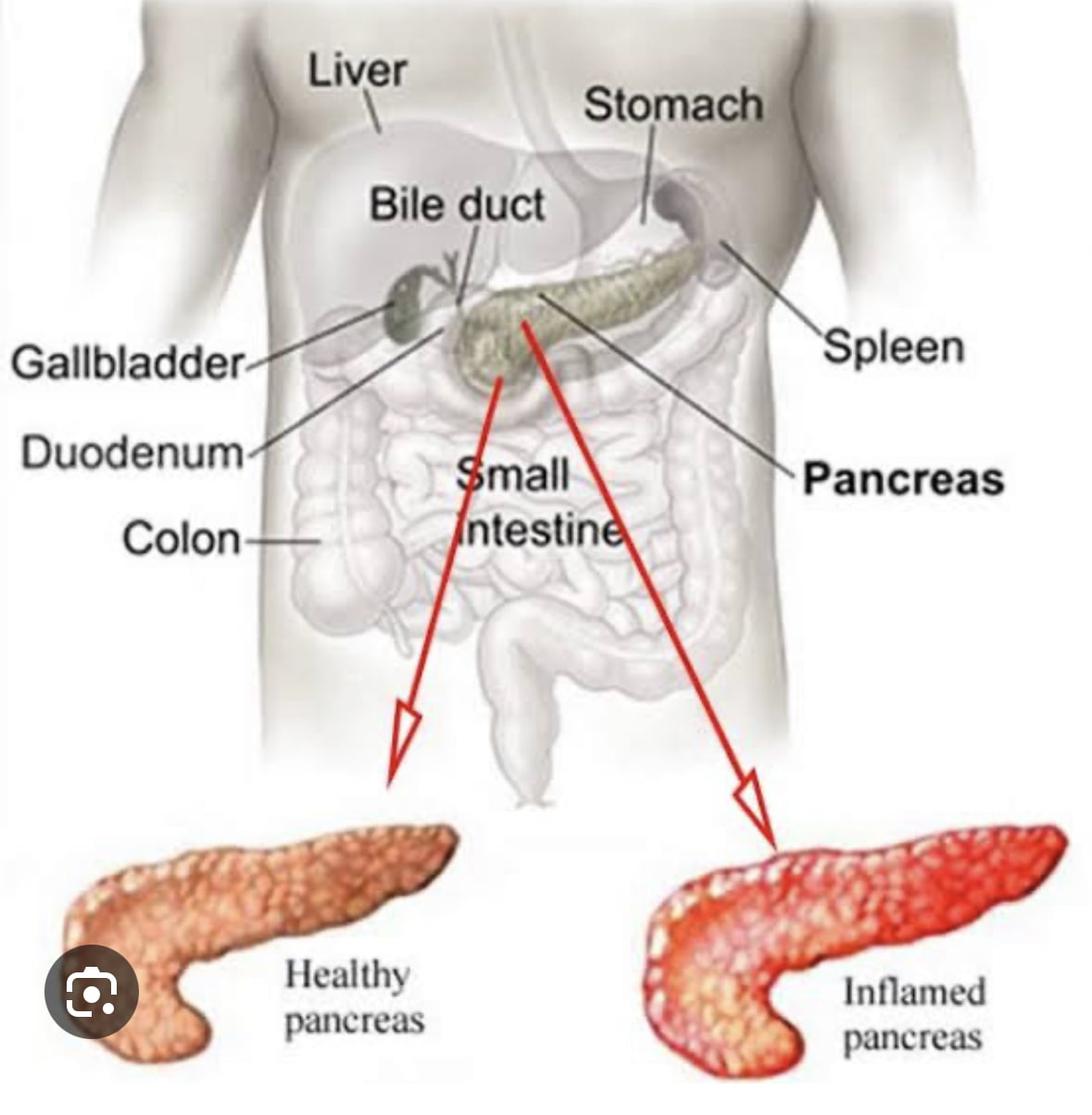 Acute Pancreatitis Causes Symptoms Diagnosis - Dr AvinashTank, is a ...