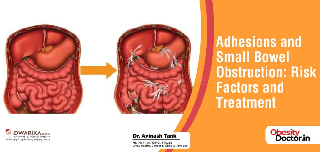 Adhesions and Small Bowel Obstruction:Risk Factors and Treatment - Dr ...