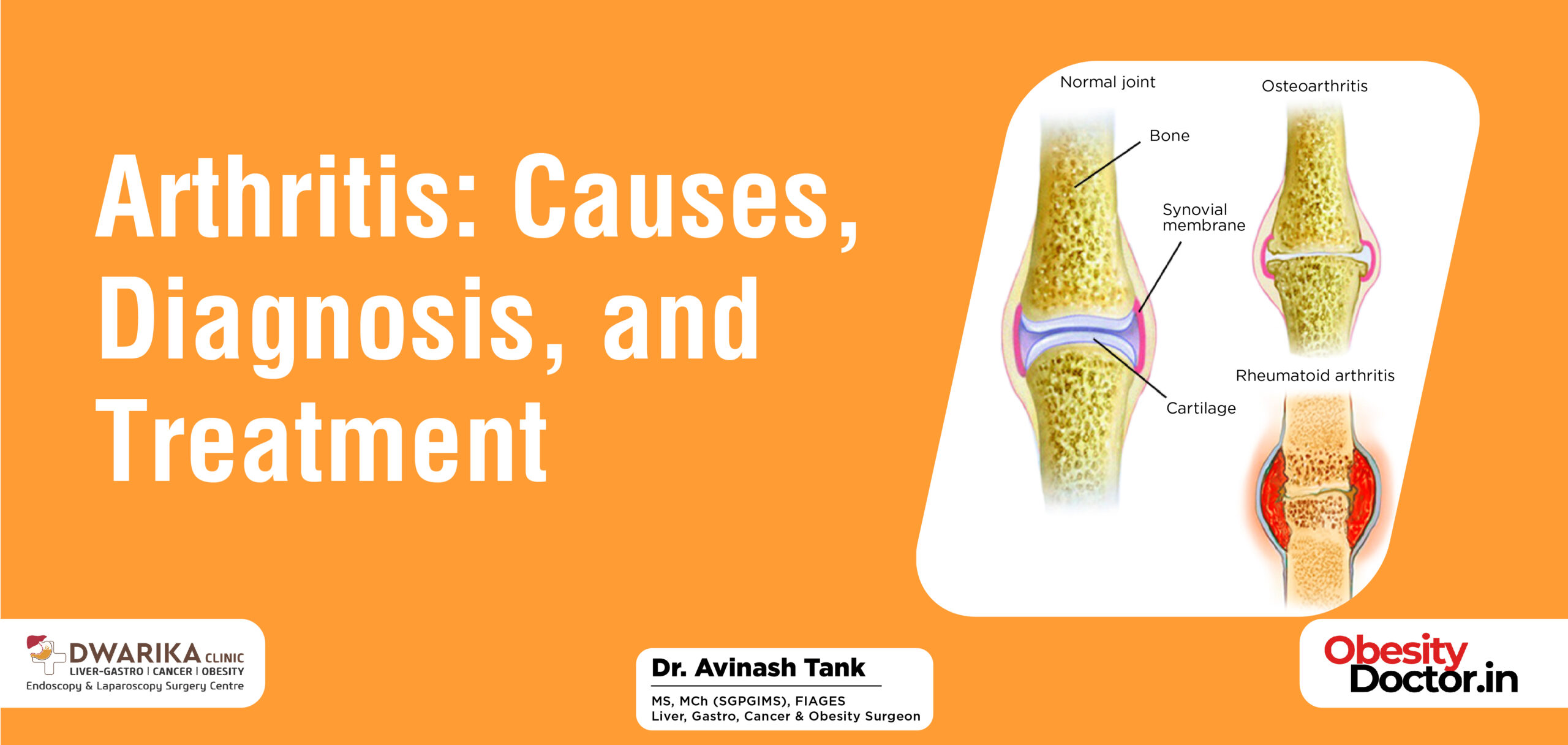 Arthritis: Causes, Diagnosis, and Treatment - Dr AvinashTank, is a super-specialist (MCh ...