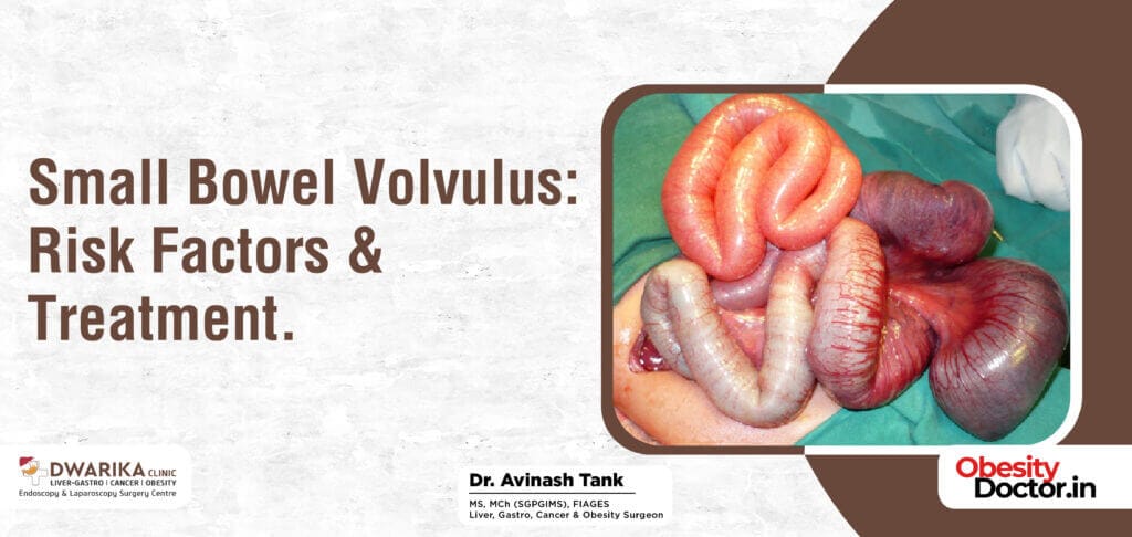 Small Bowel Volvulus: Risk Factors & Treatment. - Dr AvinashTank, is a ...