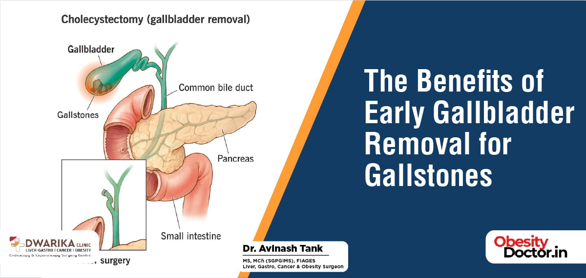 Gallbladder Archives - Dr AvinashTank, is a super-specialist (MCh ...
