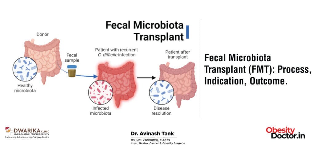 Fecal Microbiota Transplant (FMT): Process, Indication, Outcome. - Dr AvinashTank, is a super ...