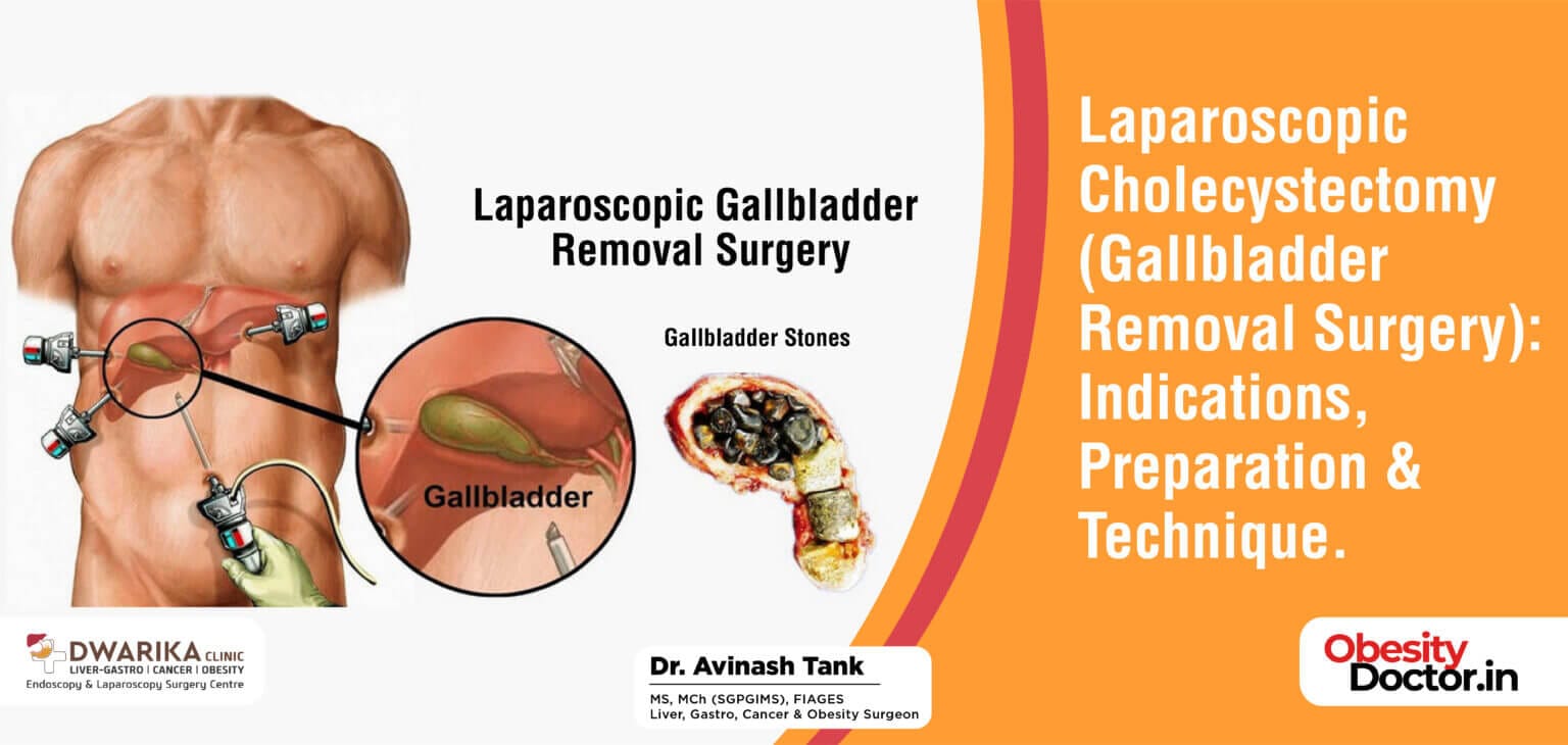 Laparoscopic Cholecystectomy ( Gallbladder Removal Surgery ...